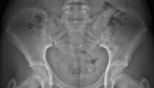 What Is A Risser Sign | Scoliosis Diagnosis | Prognosis | X=Ray
